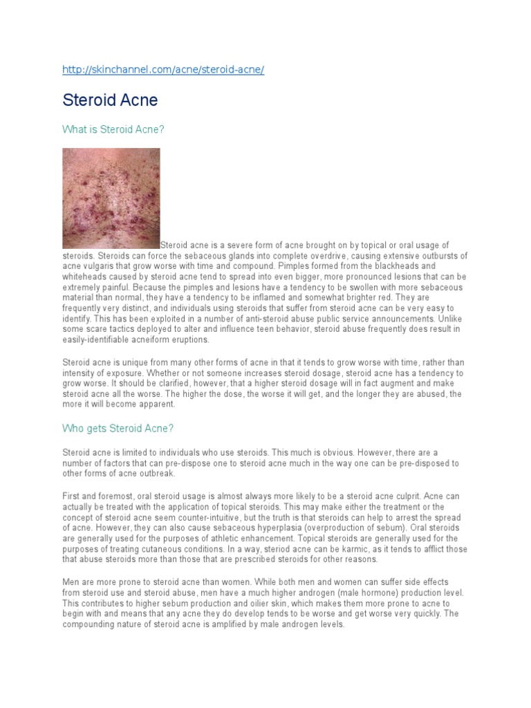 What Is Steroid Acne? | PDF | Acne Vulgaris | Pimple
