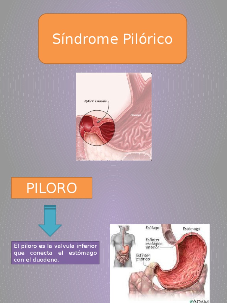Síndrome Pilórico: Diagnóstico y Tratamiento | PDF | Estómago | Úlcera ...