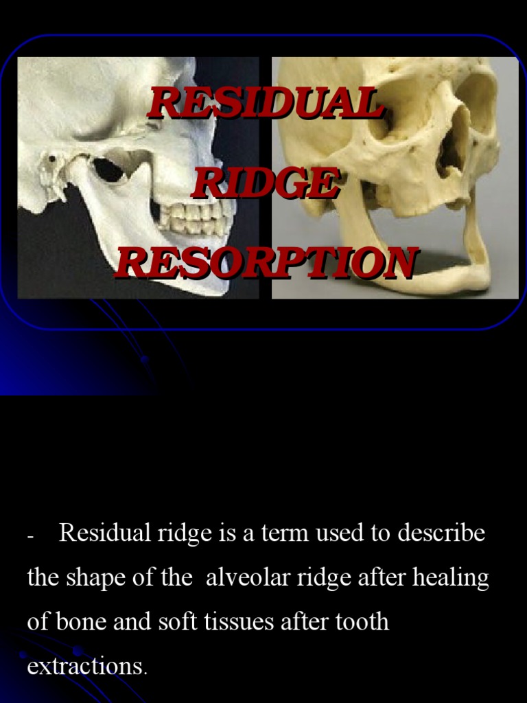 Residual Ridge