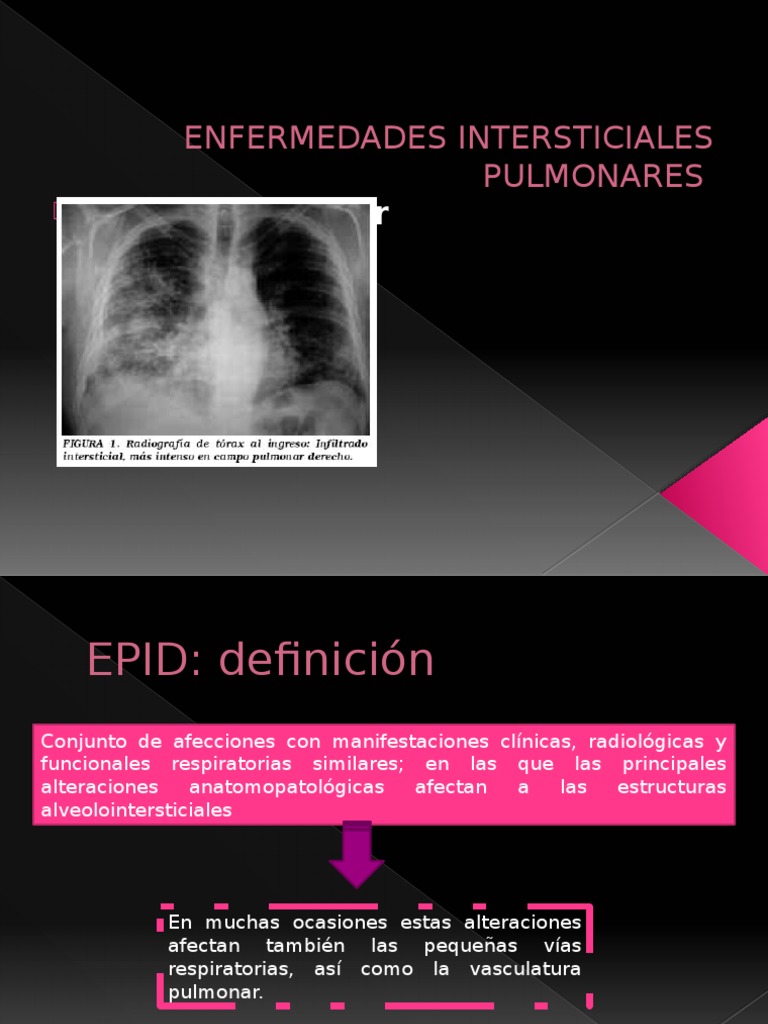 EPID | PDF | Neumonía | Medicina CLINICA