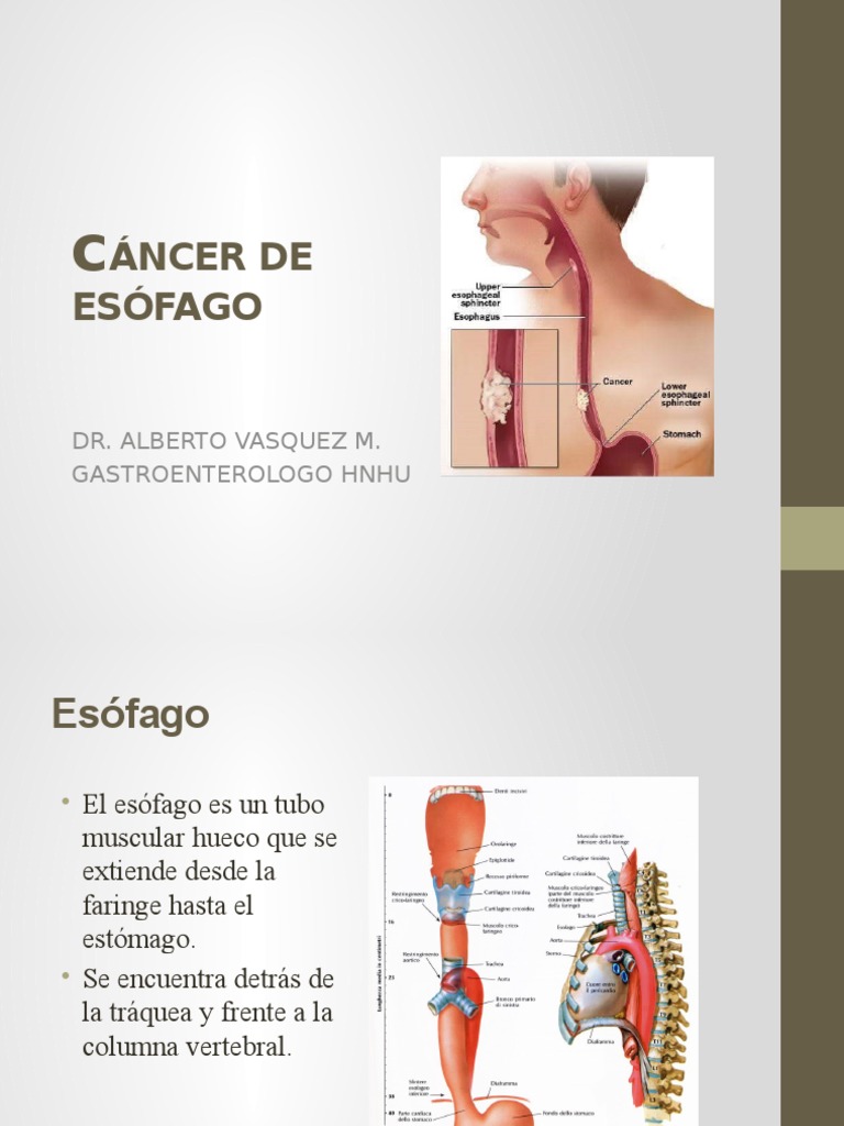 cancer esofagico | Cáncer de esófago | Cáncer