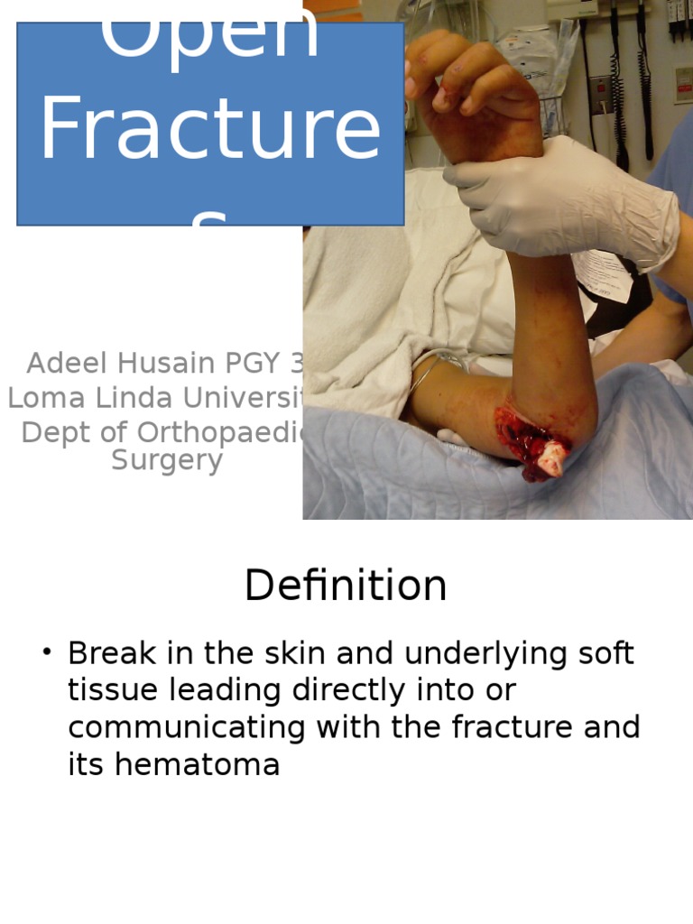 Open Fractures | Wound | Amputation