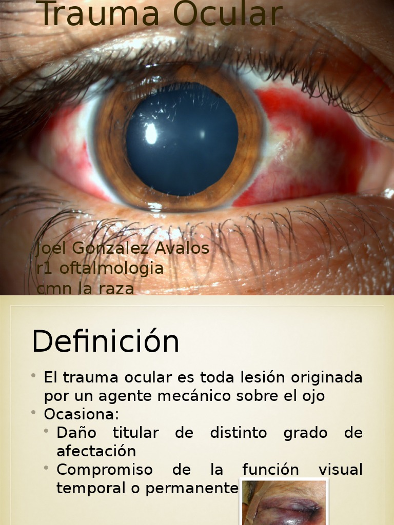 Trauma Ocular | PDF | Lesión | Ojo humano