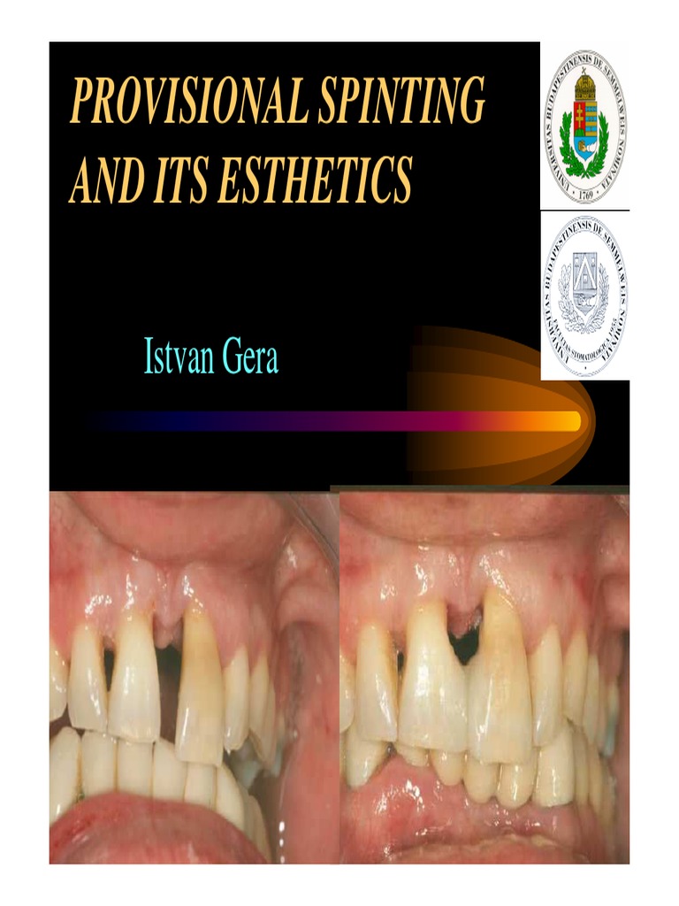 Provisional Splinting 2013 | PDF | Periodontology | Human Tooth