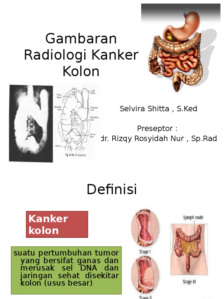 Gambaran Radiologi Kanker Kolon | PDF