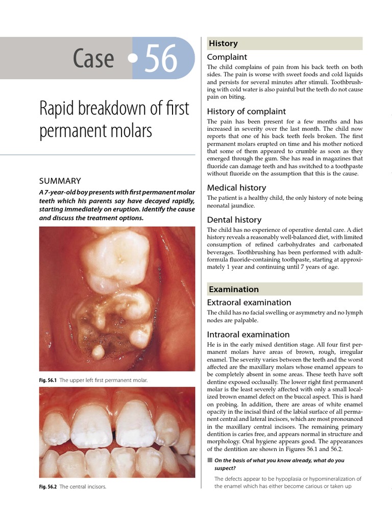 56.Rapid breakdown of first permanent molars.pdf | Tooth Enamel | Tooth