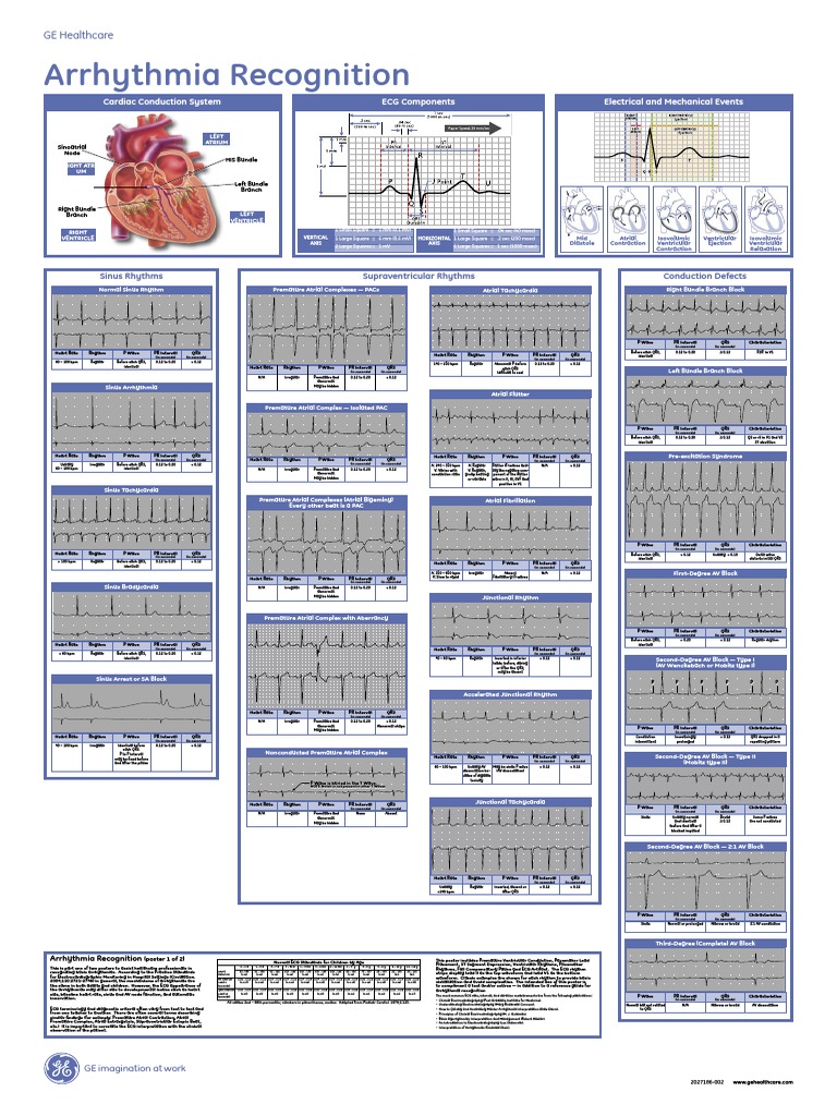 ECG Arrhythmia Recognition Guide | PDF | Cardiac Arrhythmia ...