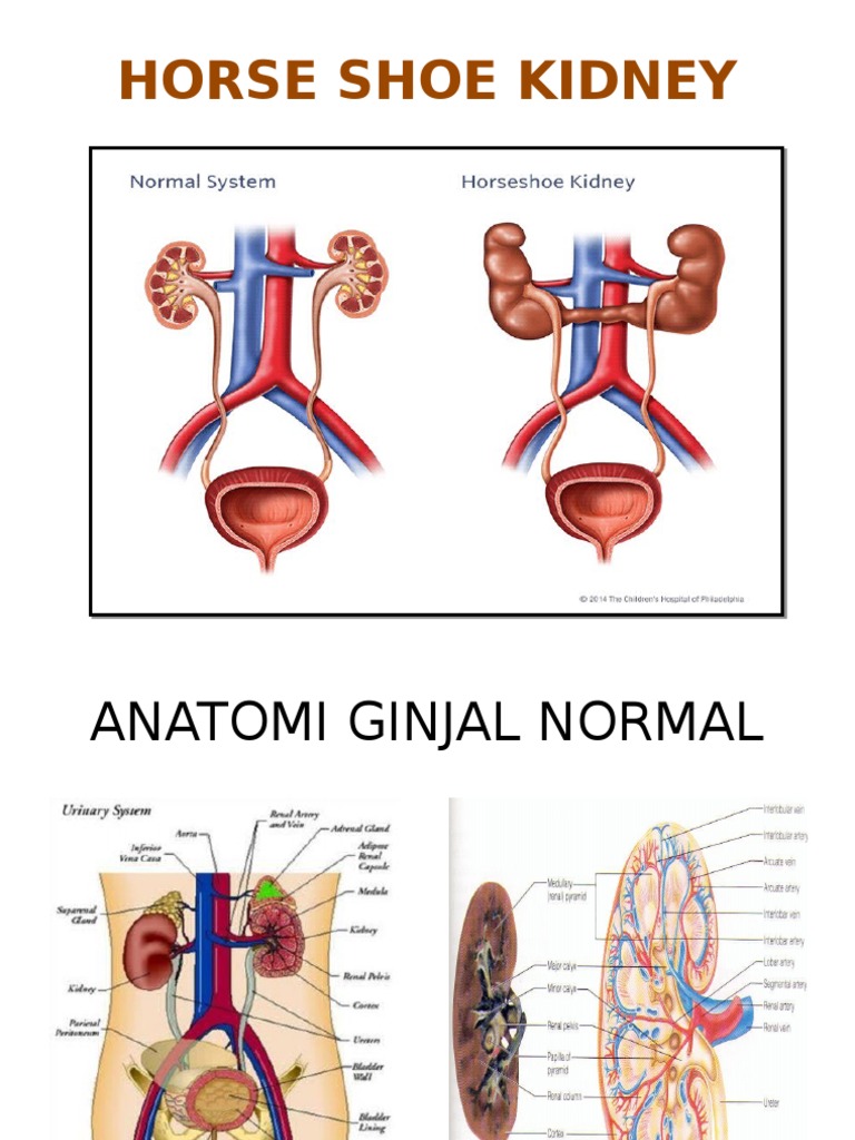 Horse Shoe Kidney | PDF