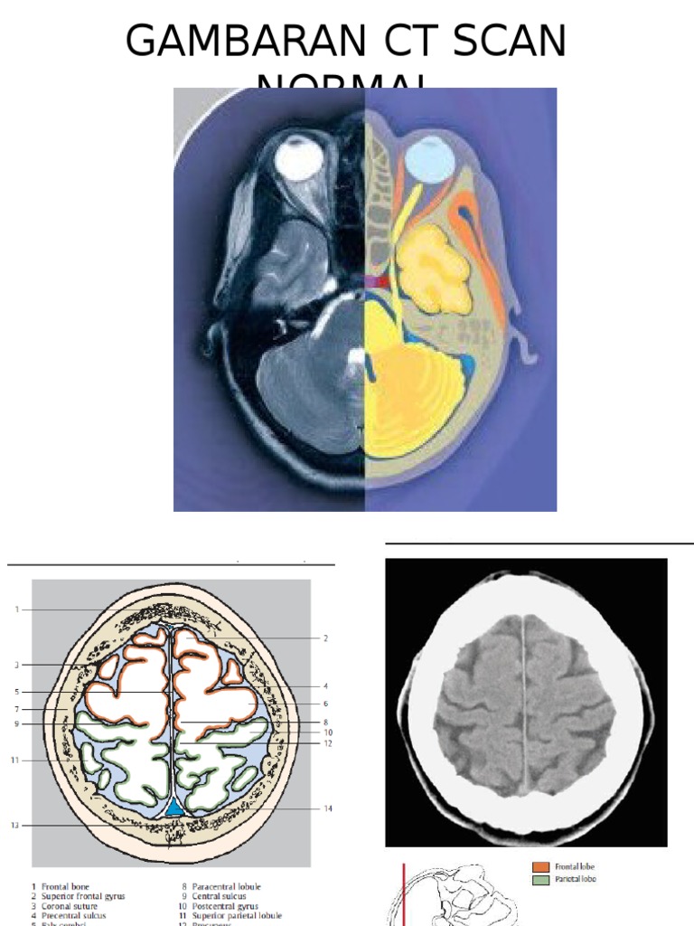Gambaran CT Scan Normal | PDF