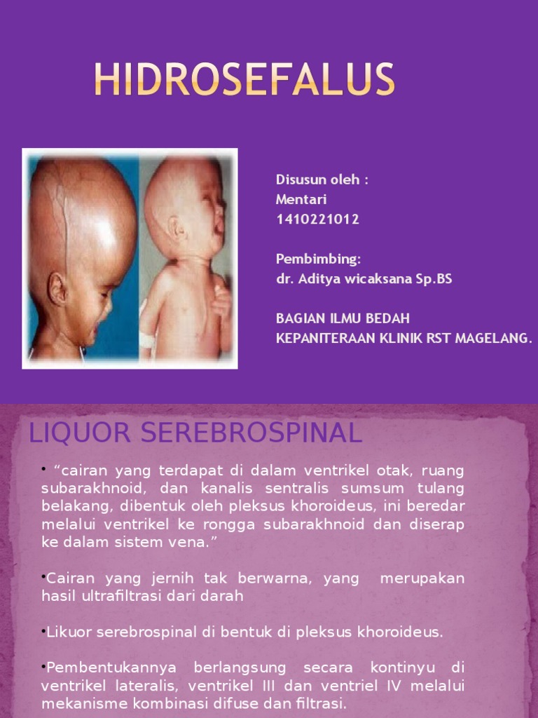 Hidrosefalus | PDF
