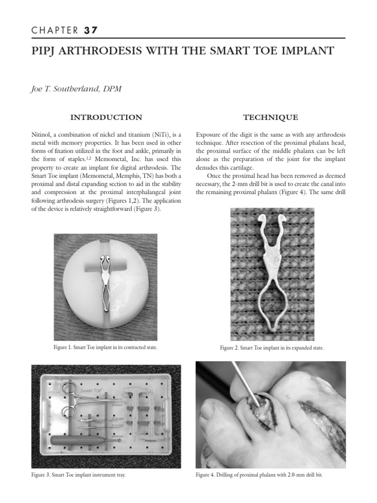 Pipj Arthrodesis With The Smart Toe Implant: Joe T. Southerland, DPM ...
