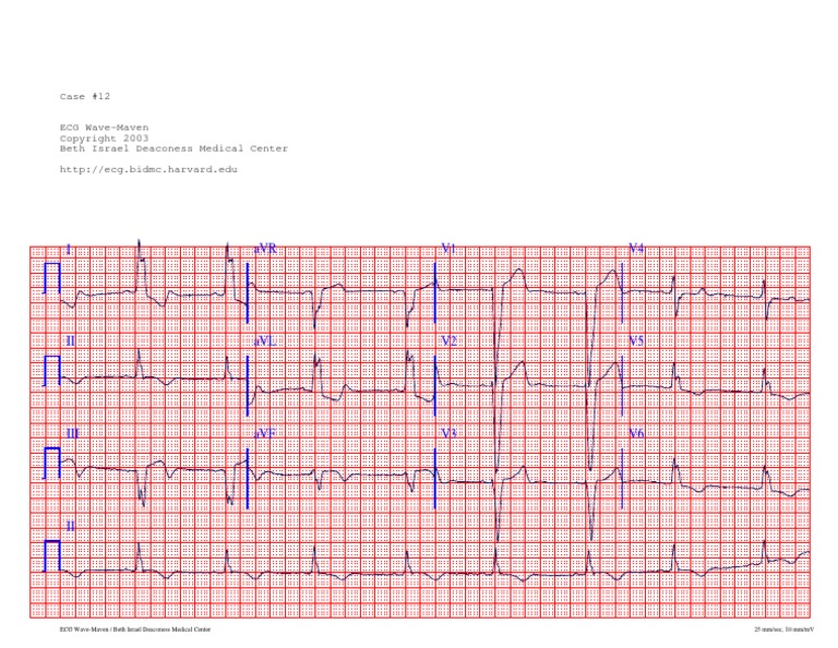 I aVR V1 V4: Case #12 | PDF | Electrocardiography | Visual Cortex