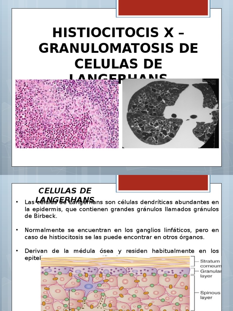 Histiocitosis X | PDF | Epidemiología | Especialidades Medicas