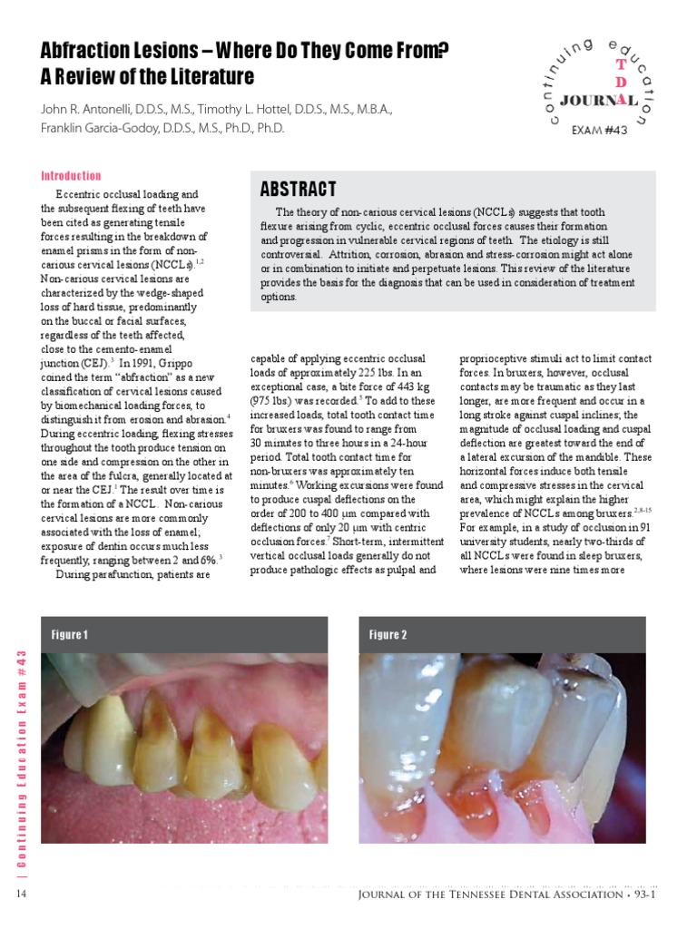 Understanding Abfraction Lesions | PDF | Tooth Enamel | Dentistry Branches