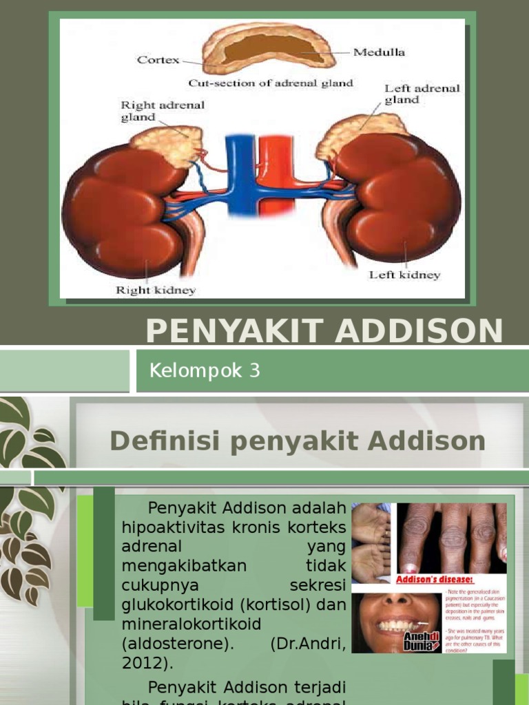 Penyakit Addison | PDF