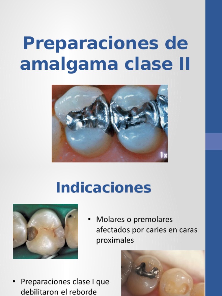 Preparación de Amalgama Clase II | PDF | Diente humano | Tornillo
