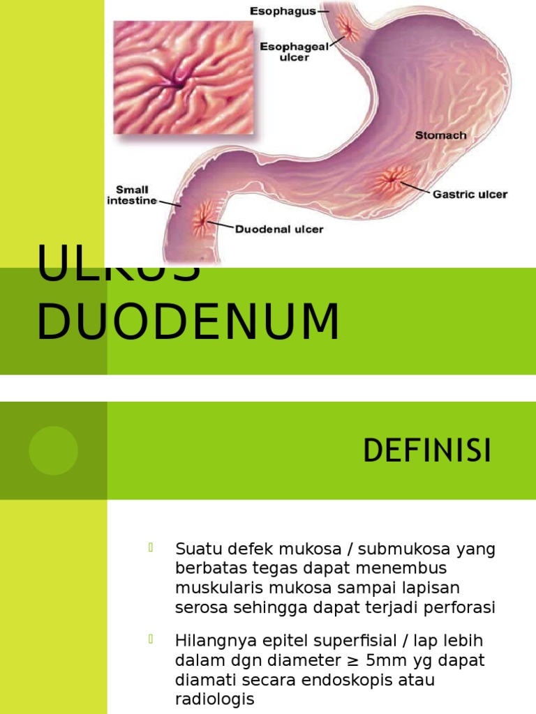 Ulkus Duodenum | PDF