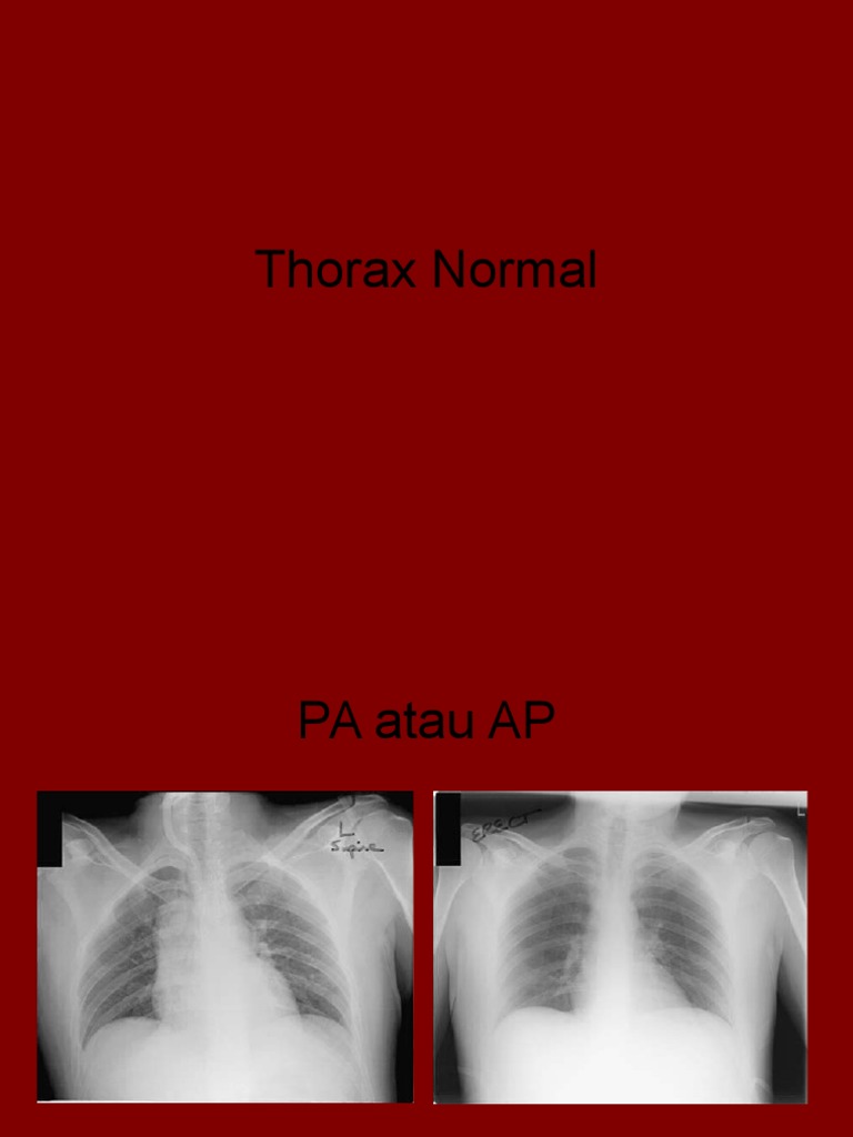 Radiologi Thorax Normal | PDF