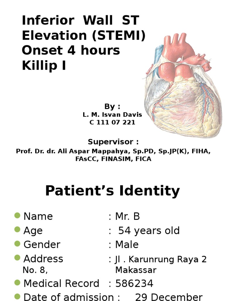 Inferior Wall ST Elevation (STEMI) | PDF | Myocardial Infarction ...