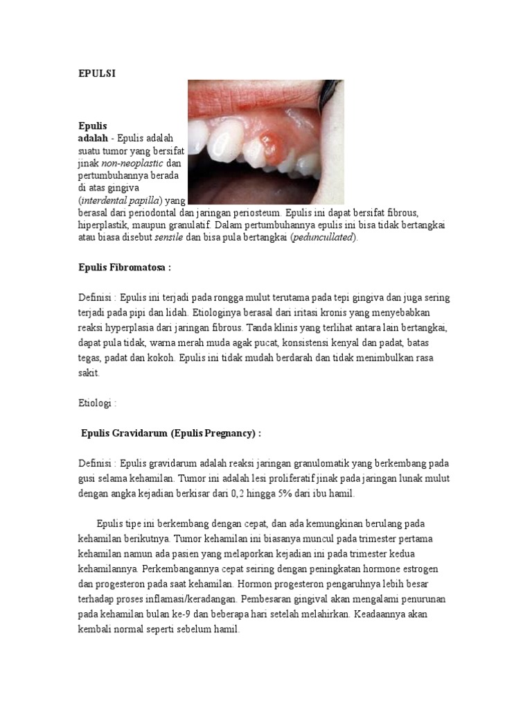 Epulis | PDF