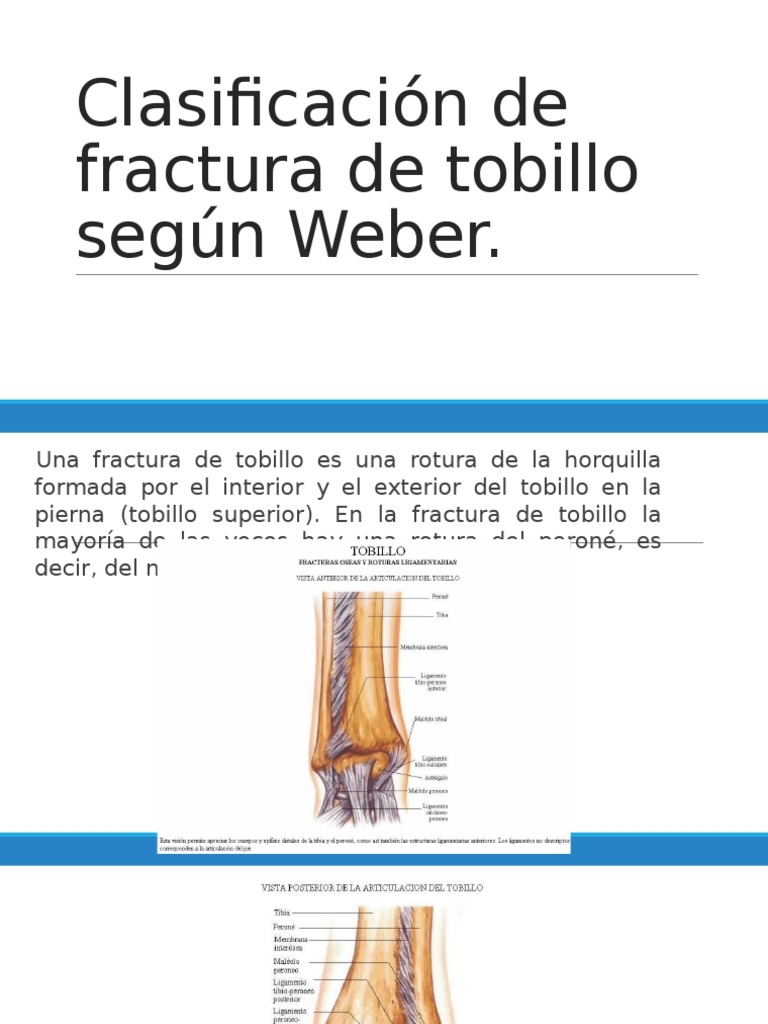 Fractura Weber Tobillo , Classification de la fracture de Weber : types ...