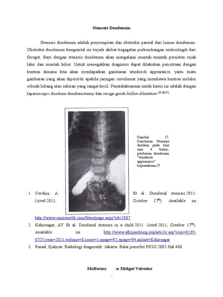 Stenosis Duodenum | PDF