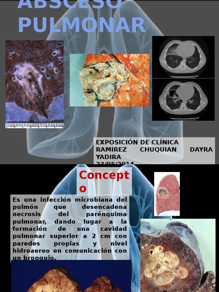 Diagnóstico y tratamiento del absceso pulmonar | PDF | Pulmón | Infección
