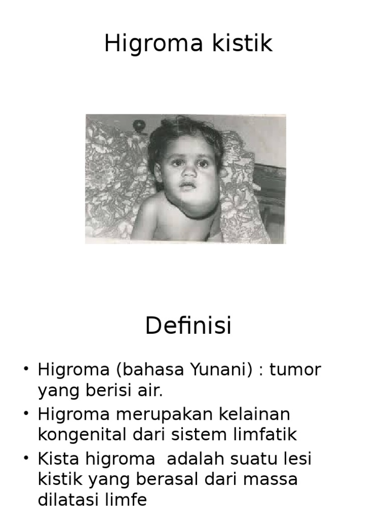 Higroma Kistik | PDF