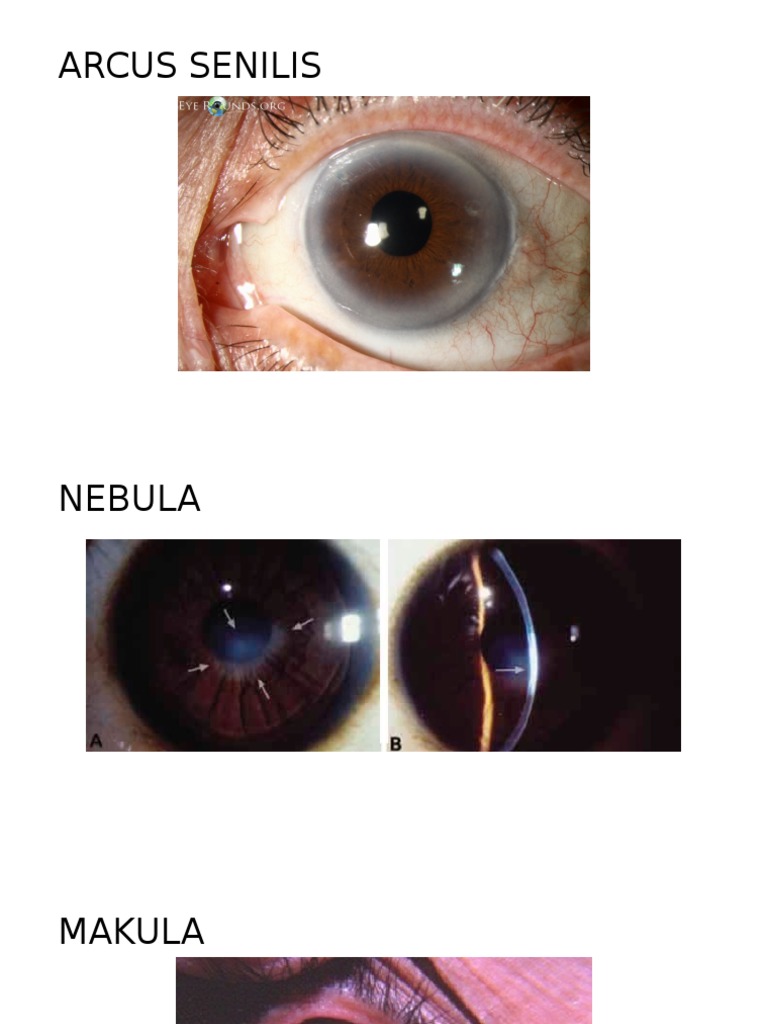 Arcus Senilis | PDF