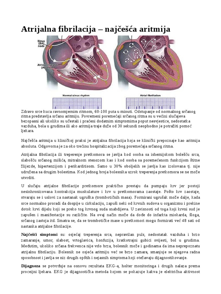 Atrijalna fibrilacija – najčešća aritmija srce.odt | PDF