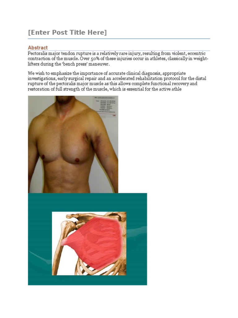Pectoralis Major Rupture | PDF | Shoulder | Dance Science