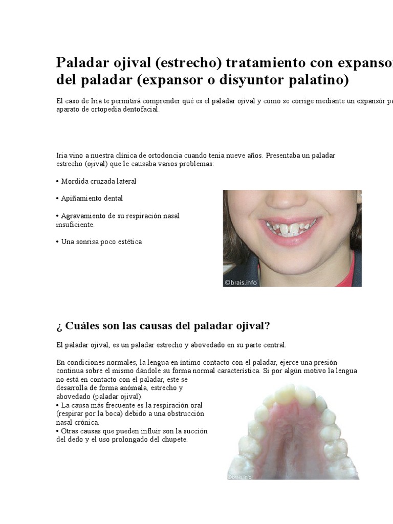 Tratamiento del paladar ojival en niños | PDF | Ortodoncia | Medicina