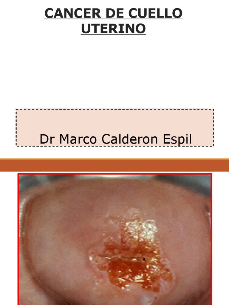 Cancer de Cervix | PDF | Cáncer de cuello uterino | Cáncer