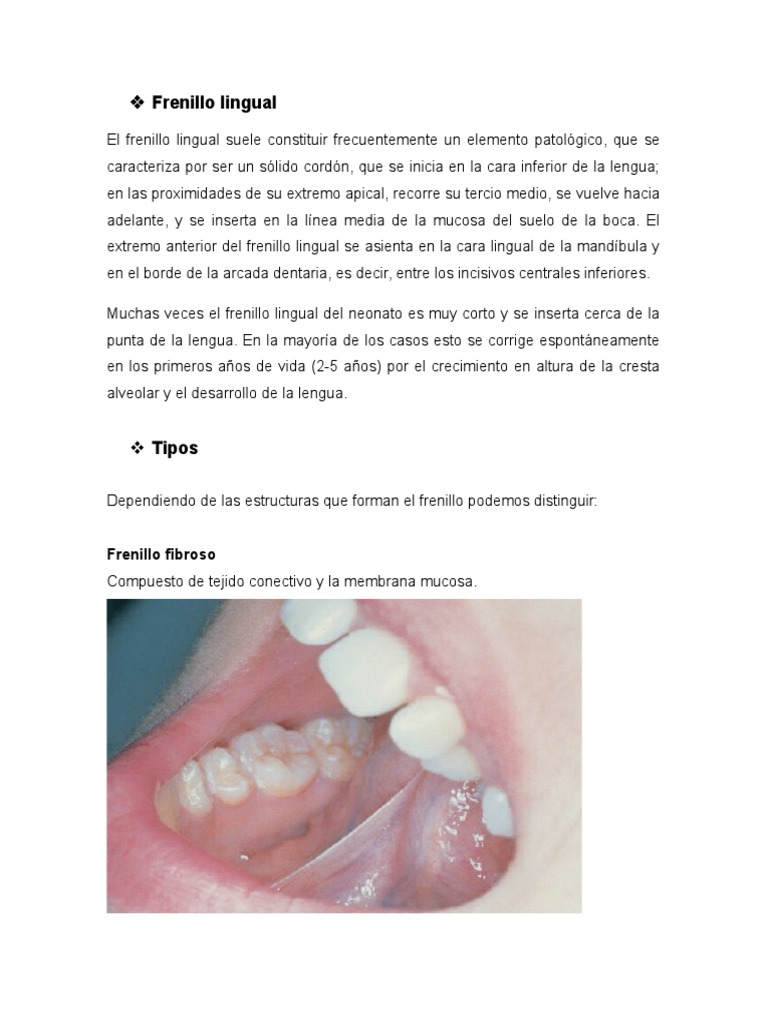 Clasificación y Patologías del Frenillo Lingual | PDF | Lengua ...