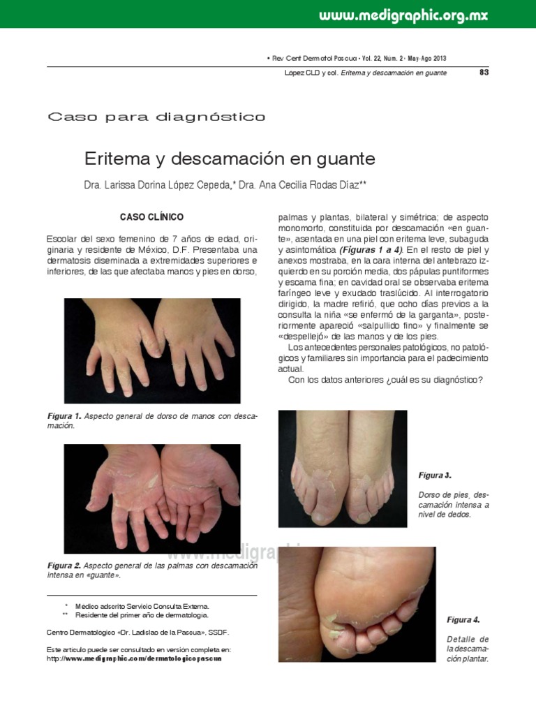Eritema y descamacion en guante | Enfermedades y trastornos | Medicina
