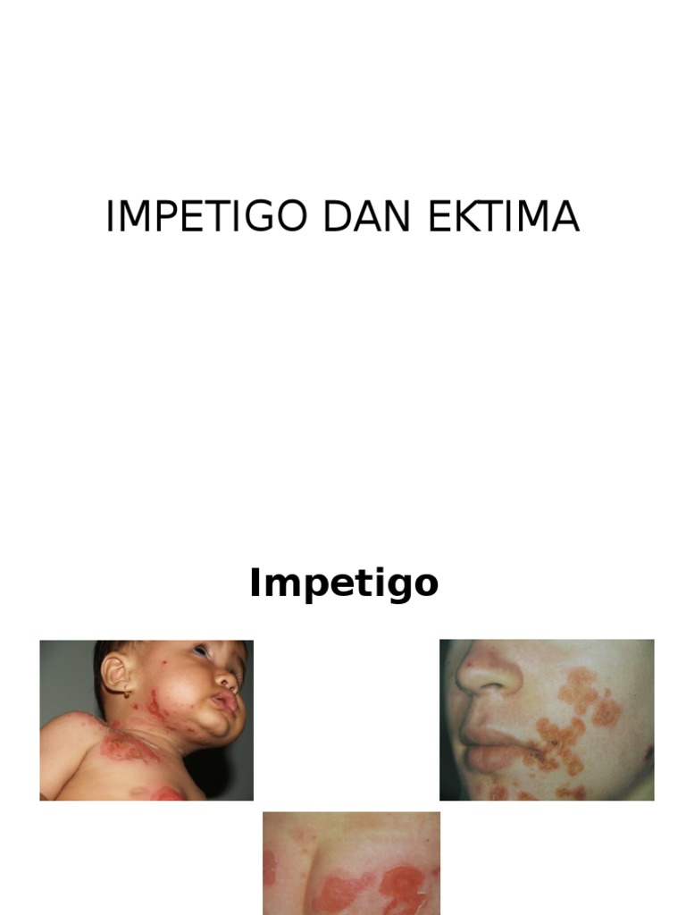 Impetigo Ektima | PDF