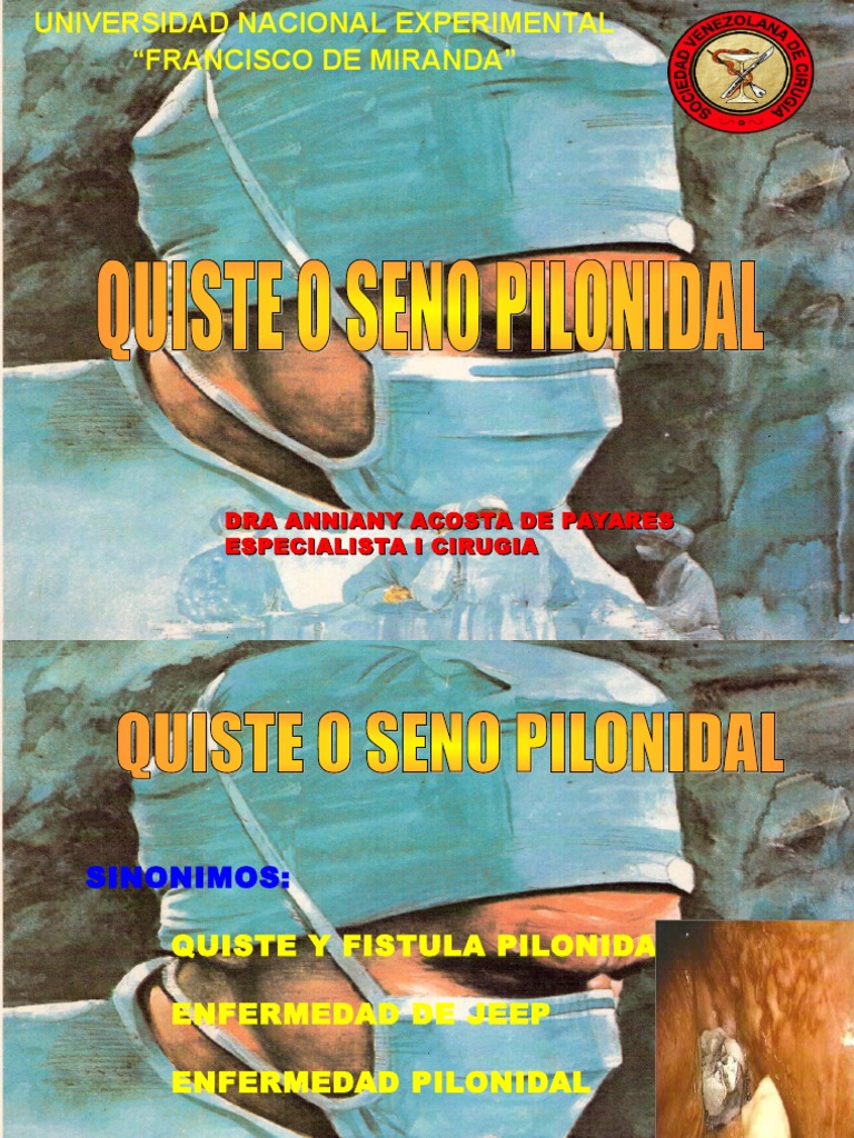 Quiste Pilonidal | PDF