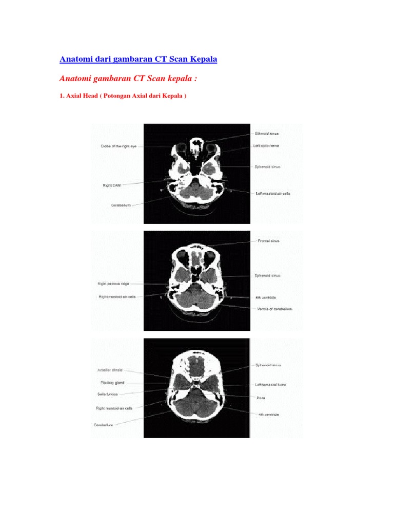 Anatomi Dari Gambaran CT Scan Kepala | PDF
