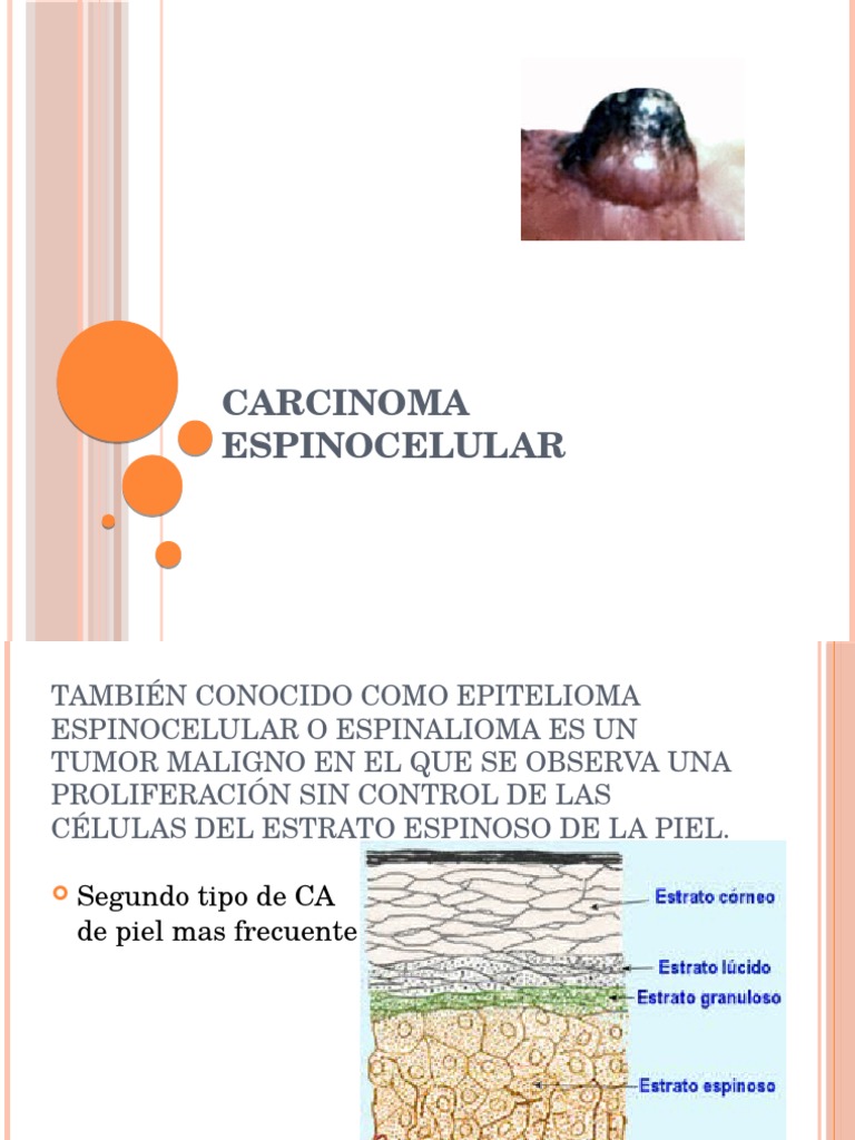 Carcinoma Espinocelular: Guía Básica | PDF