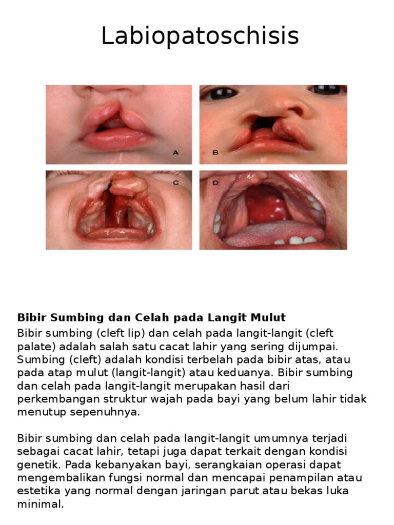 Bibir Sumbing Dan Celah Pada Langit Mulut | PDF