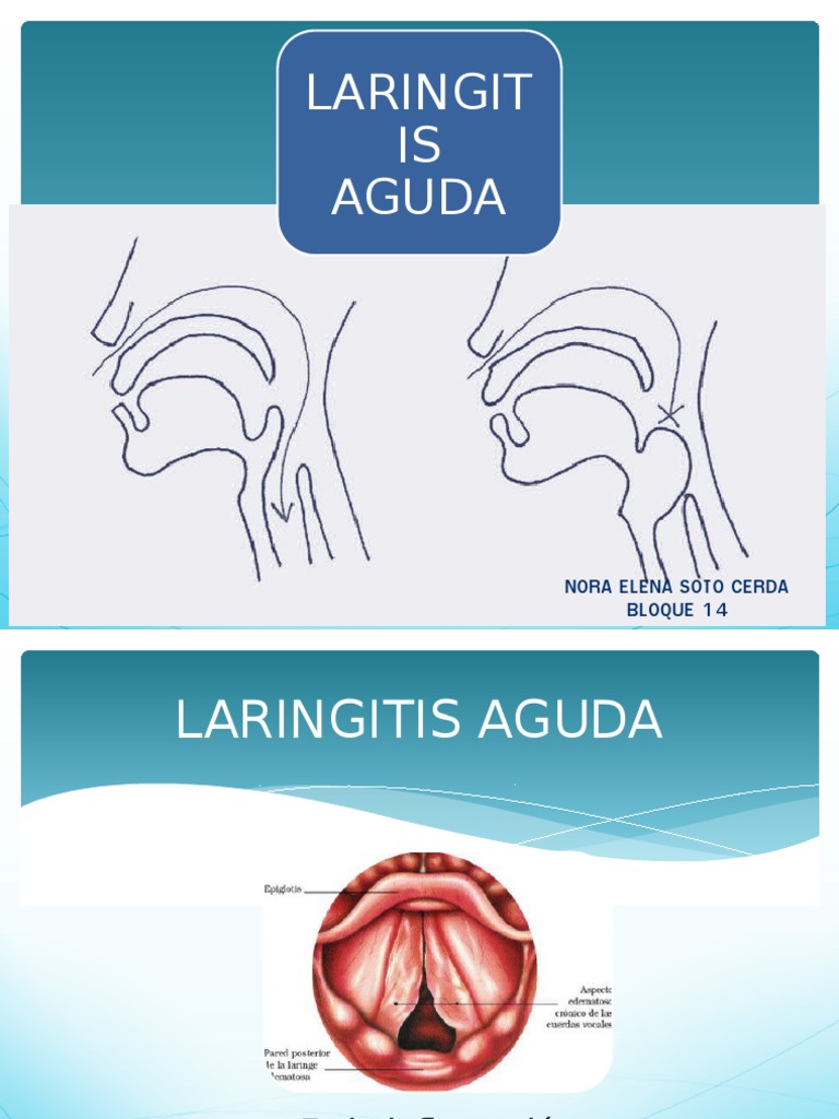 laringitis aguda y cronica 12 | Rtt | Especialidades Medicas