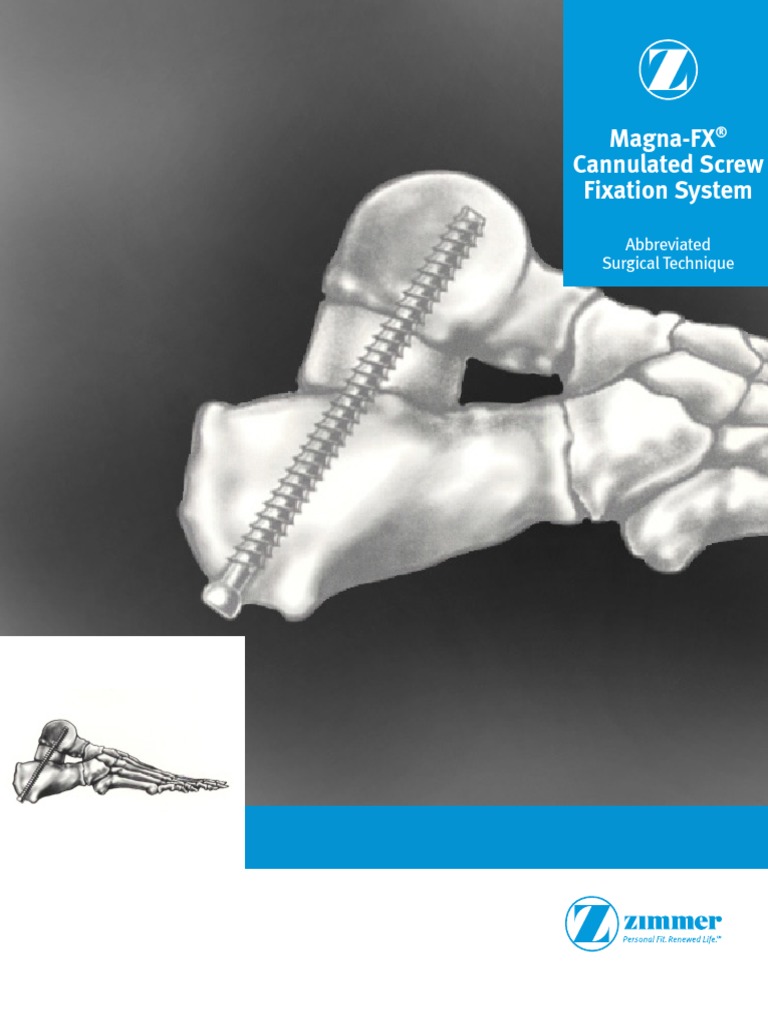 Magna Fx Cannulated Screw Fixation Sytem Abbreviated Surgical Technique ...