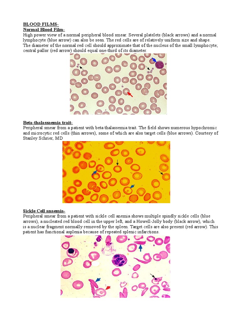 Haematology - Blood Films. | Download Free PDF | Anemia | Blood