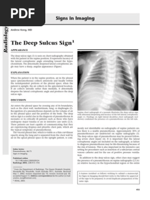 Deep Sulcus Sign Emergency Medicine Journal