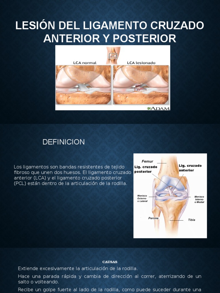 Lesión Del Ligamento Cruzado Anterior y Posterior | PDF | Rodilla ...