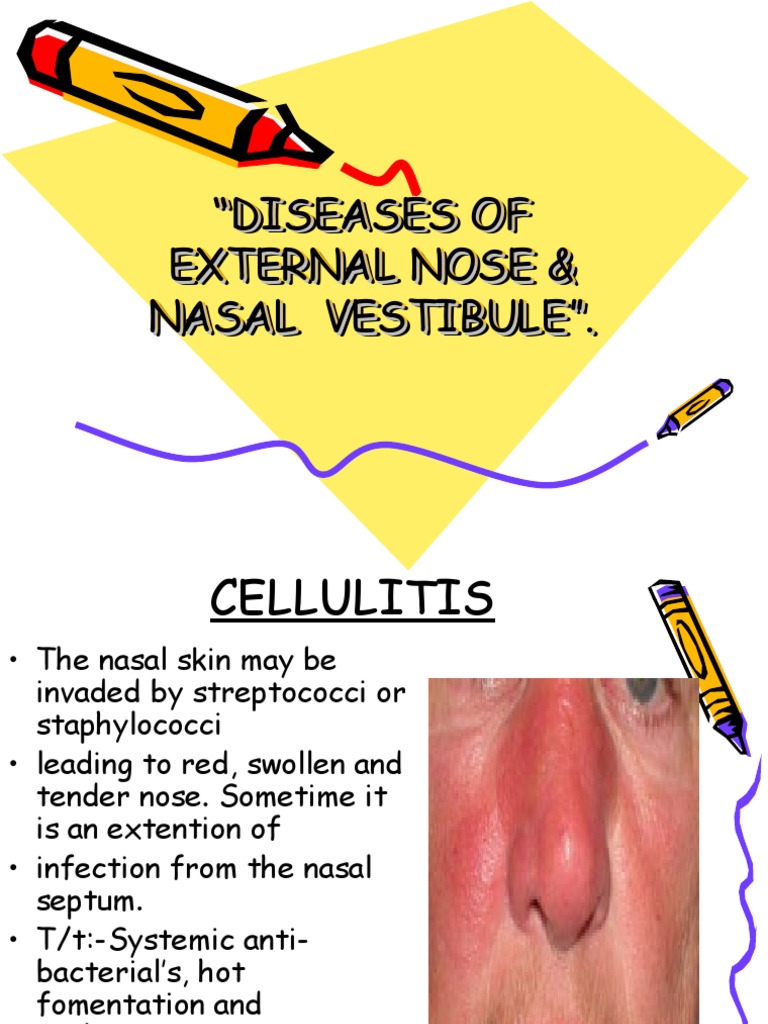 Diseases of External Nose & Nasal Vestibule | Human Nose | Neoplasms