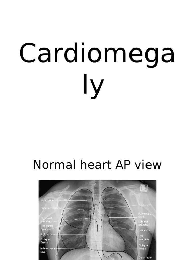 Cardiomegaly, Radiology | Heart | Ventricle (Heart)