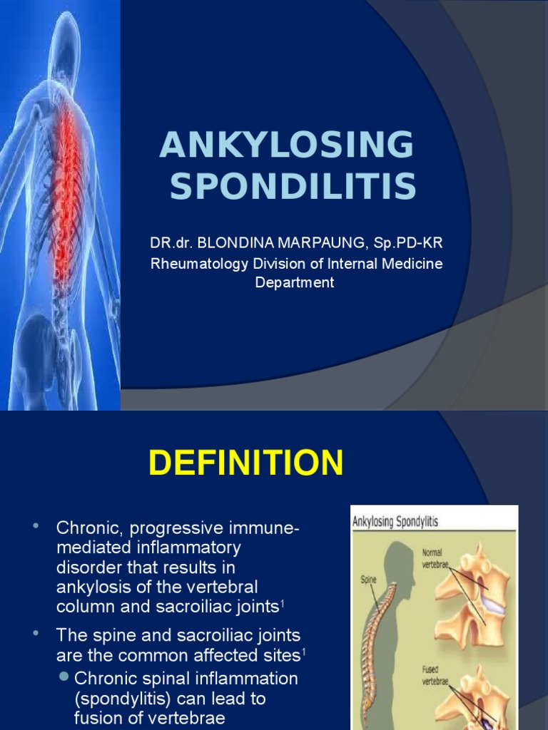 Understanding Ankylosing Spondylitis | PDF | Health Sciences | Diseases ...