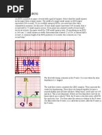 Delta Wave - LITFL Medical Blog - ECG Library Basics | PDF | Medical ...