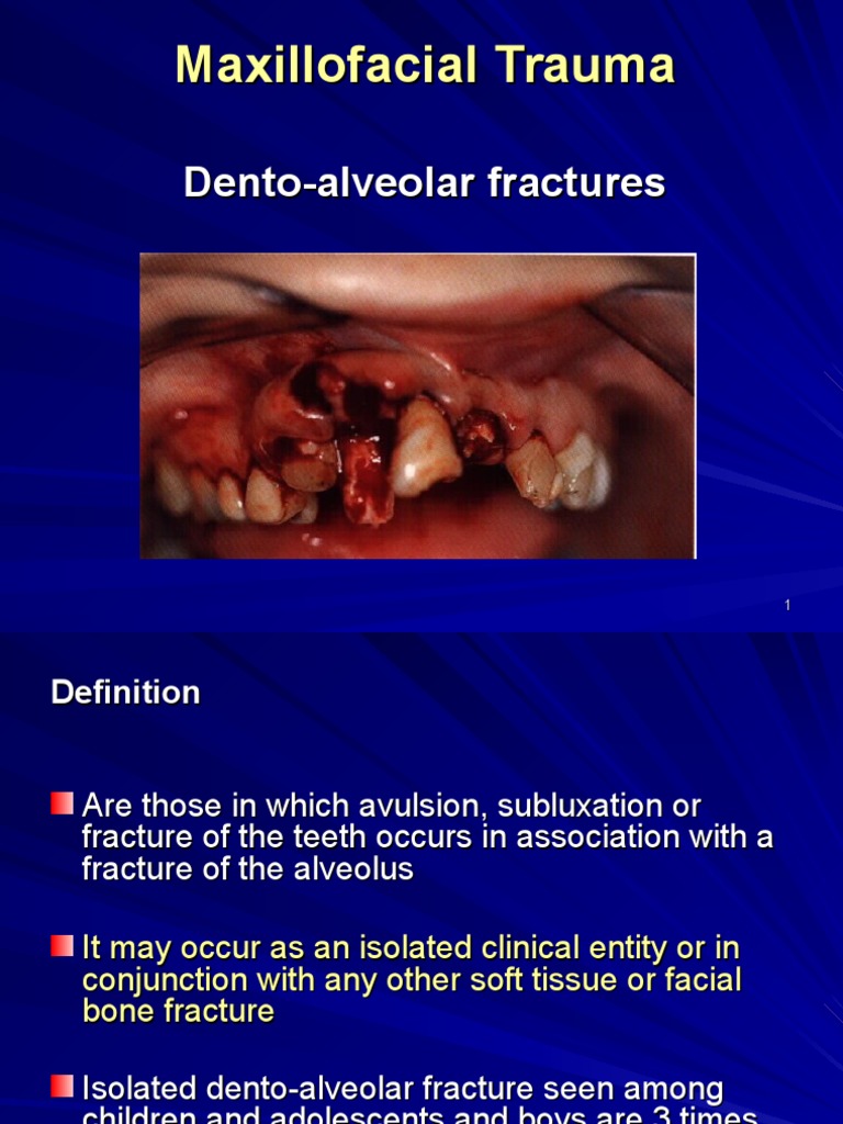 Dento Alveolar Fractures | Tooth | Dentistry